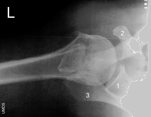 Solved Os Acromiale Findings This Is An Axial View Of The Shoulder
